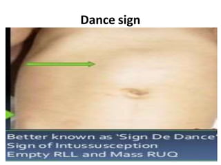 intussusceptIon | PPT