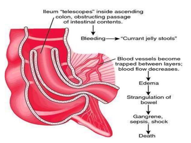intussusceptIon | PPT