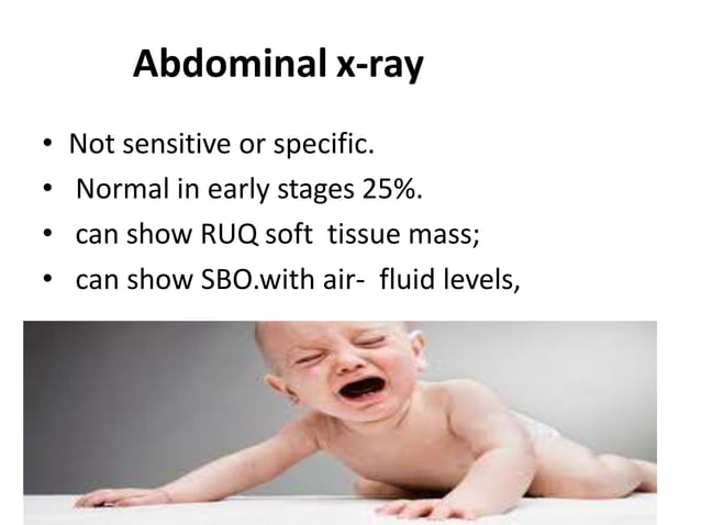 intussusceptIon | PPT