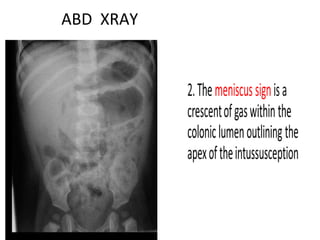 intussusceptIon | PPT