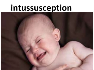 intussusceptIon | PPT