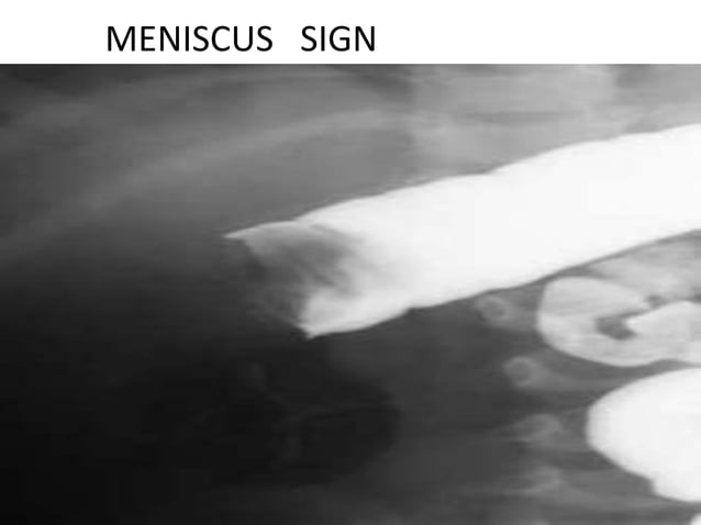 intussusceptIon | PPT