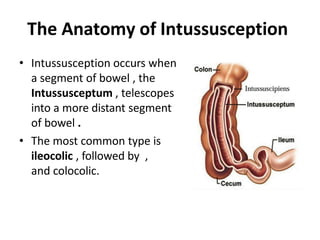 intussusceptIon | PPT