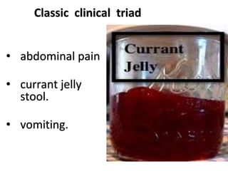intussusceptIon | PPT