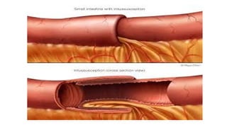 Nursing management of children with intussusception | PPTX