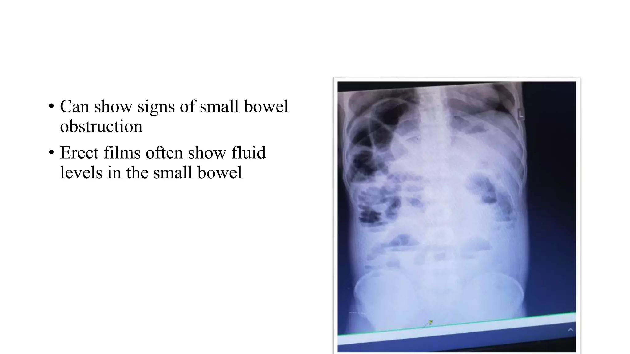 Intussusception in adults | PPTX