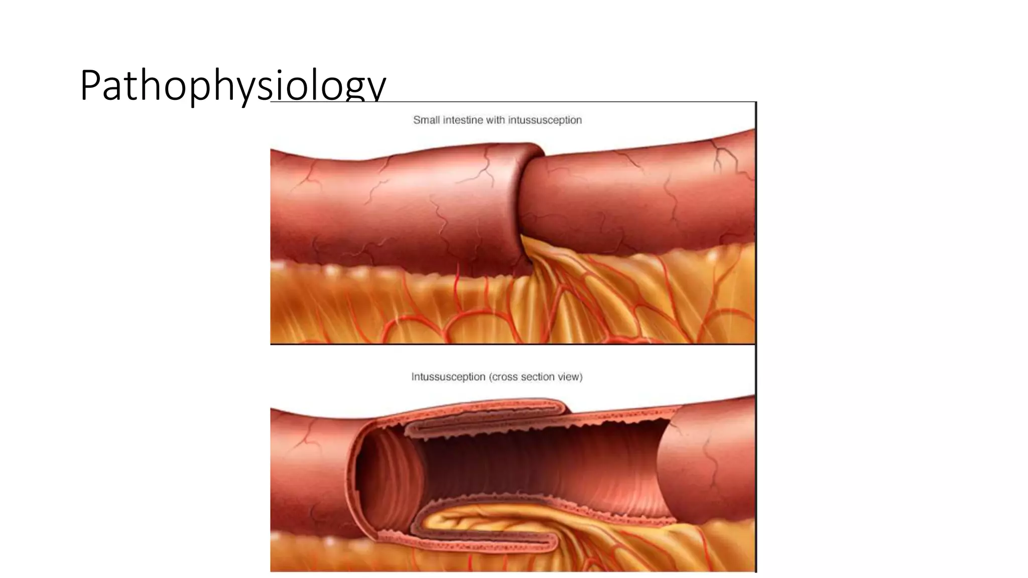 Intussusception in adults | PPTX