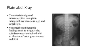 Intussusception in adults | PPTX