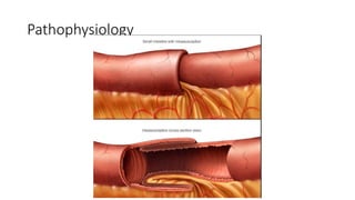 Intussusception in adults | PPTX
