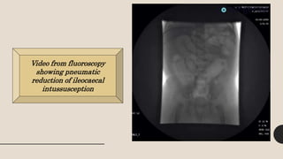 Intussusceptionlecture by Amr Abdellatif.pptx
