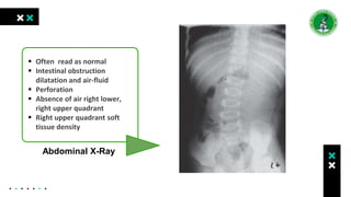 INTUSSUSCEPTION NEW power point fixed presentasion | PPTX