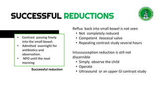 INTUSSUSCEPTION NEW power point fixed presentasion | PPTX