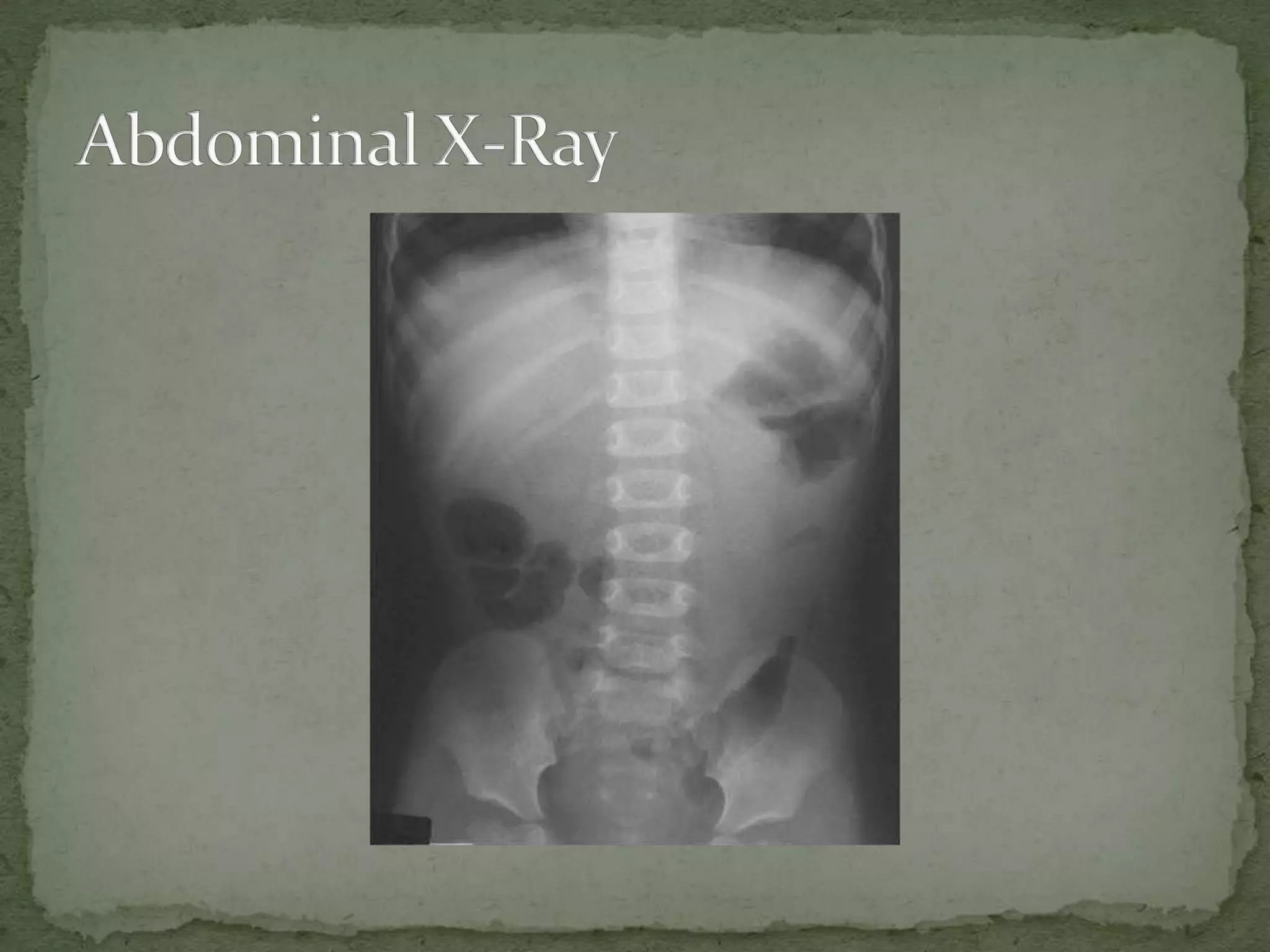 Intussusception power point (3) | PPTX