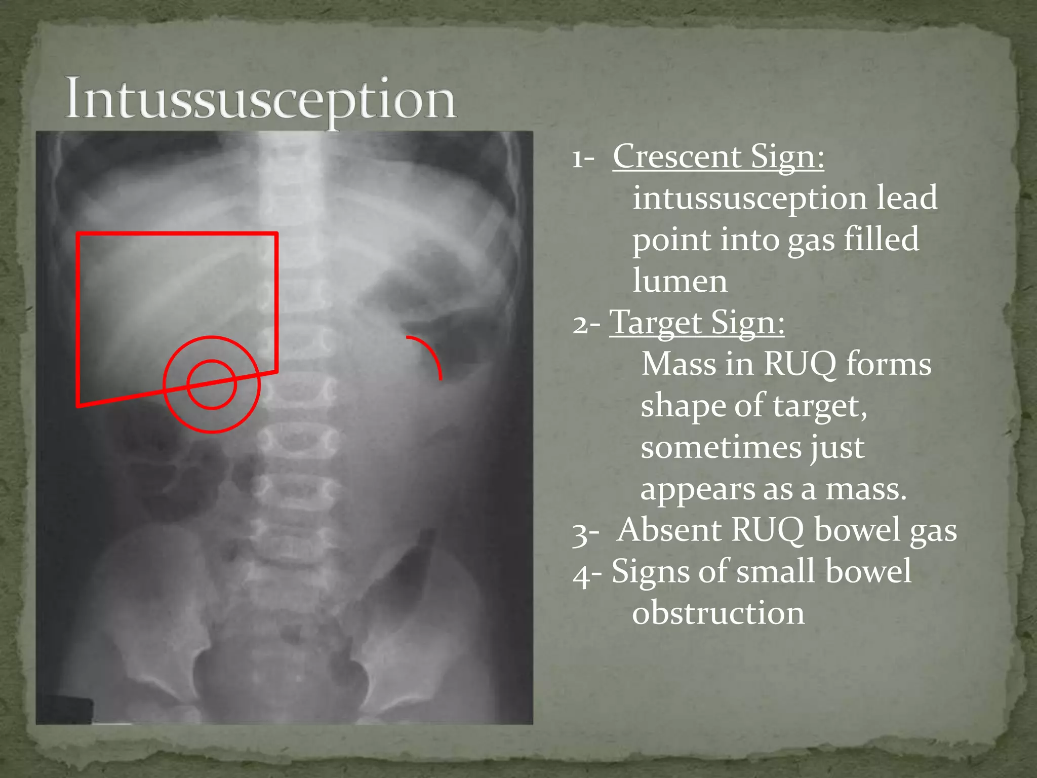 Intussusception power point (3) | PPTX