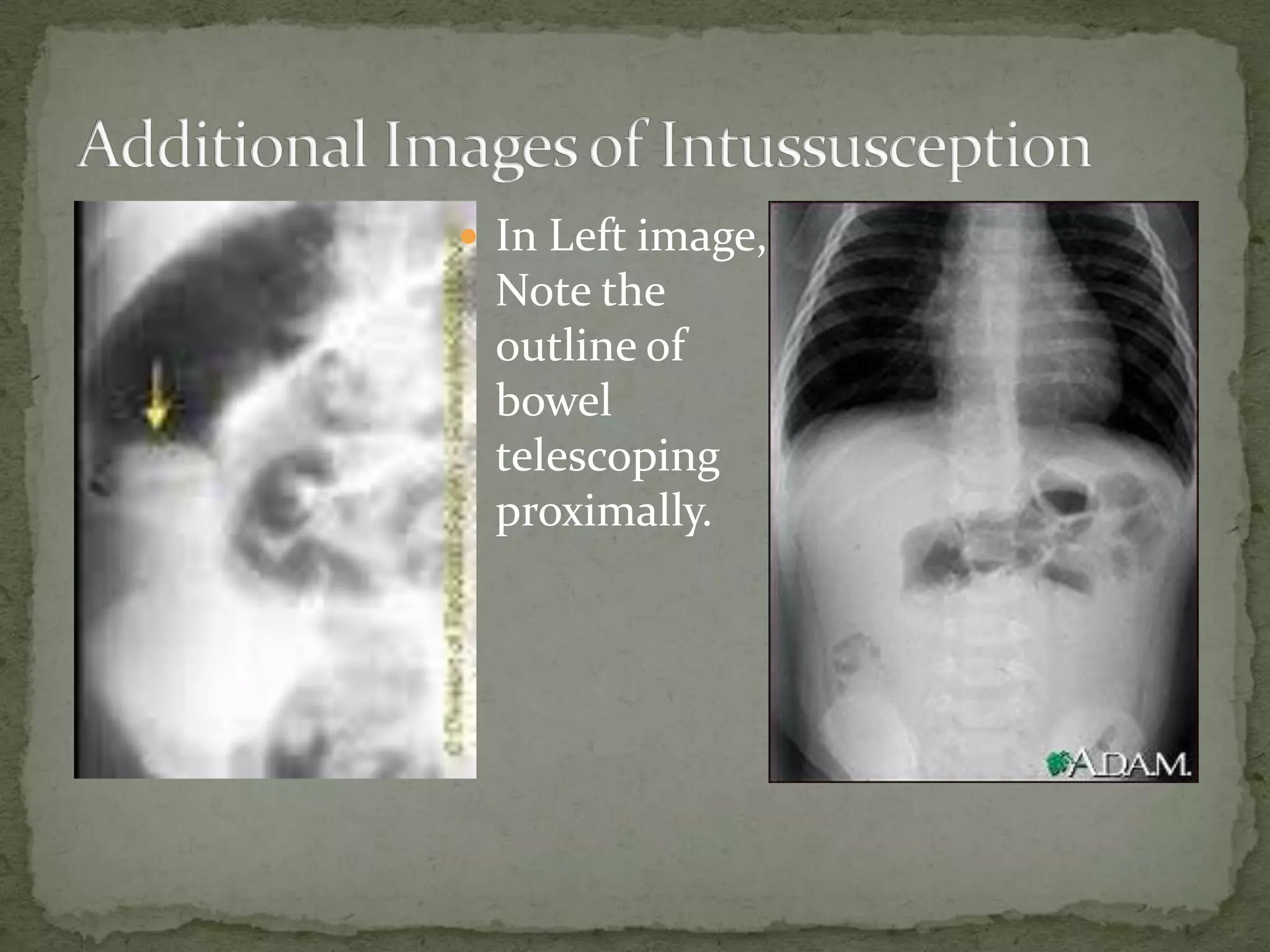 Intussusception power point (3) | PPTX