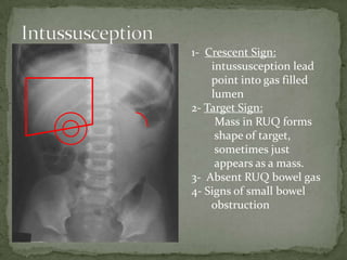 Intussusception power point (3) | PPTX