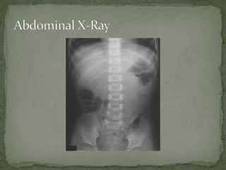 Intussusception Crescent Sign