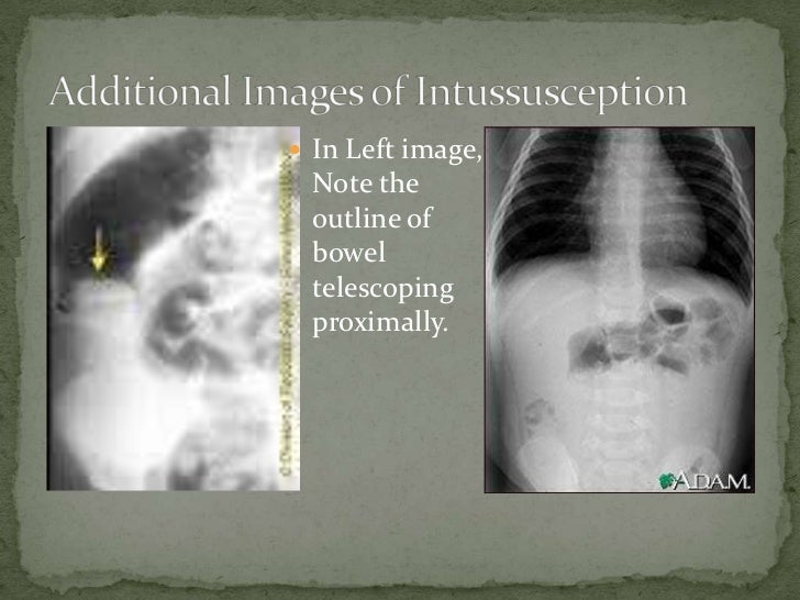 Intussusception power point (3)