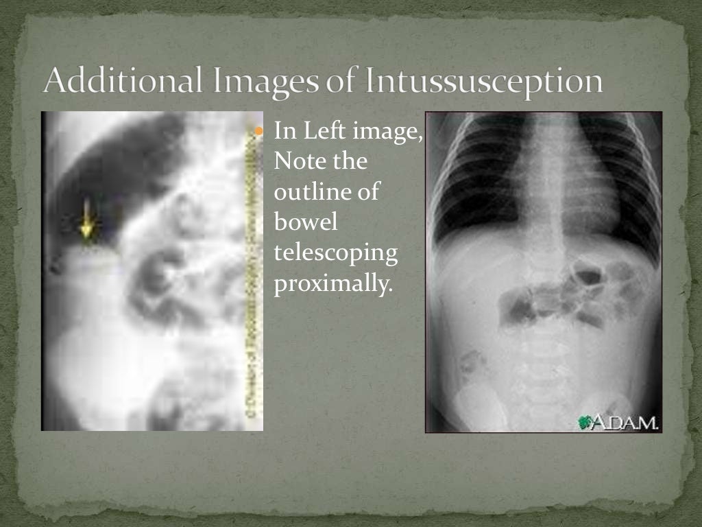 Intussusception power point (3)