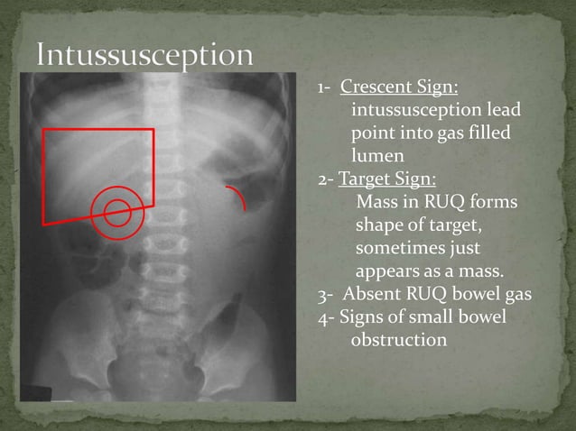 Intussusception power point | PPT