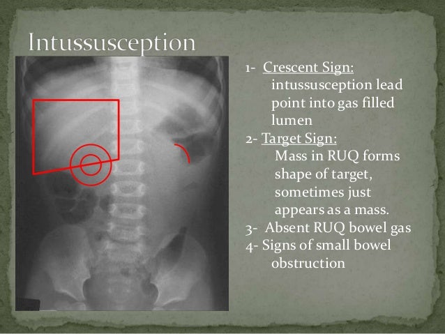 Intussusception power point
