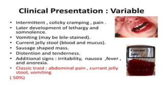 INTUSSUSCEPTION ,MANAGEMENT AND COMPLICATIONS | PPTX