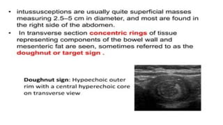 INTUSSUSCEPTION ,MANAGEMENT AND COMPLICATIONS | PPTX