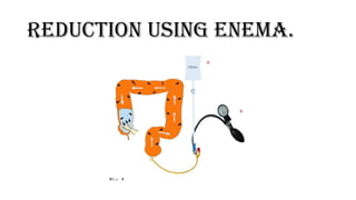 INTUSSUSCEPTION ,MANAGEMENT AND COMPLICATIONS | PPTX