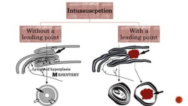 INTUSSUSCEPTION ,MANAGEMENT AND COMPLICATIONS | PPT