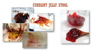 Intussusception | PDF