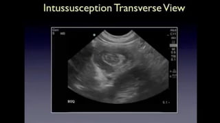Intussusception | PDF