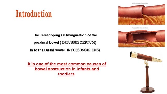 Intussusception | PDF