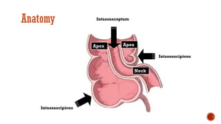 Intussusception | PDF
