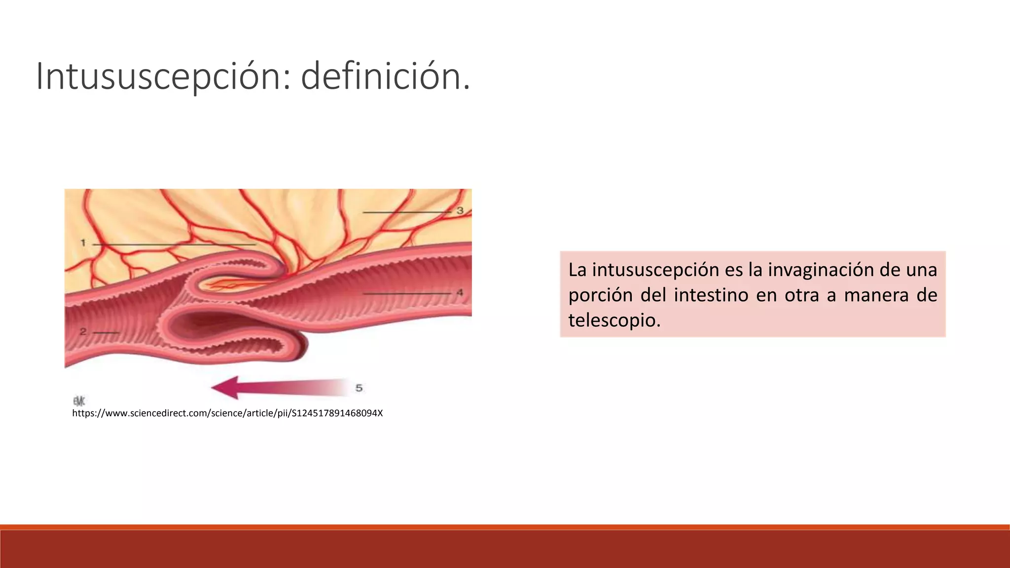 Intususcepcion | PPTX | Digestive Disorders | Diseases and Conditions