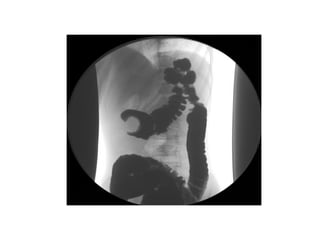 Intussusception Barium Enema Claw Sign