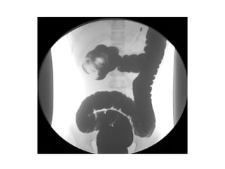 Intussusception Barium Enema Claw Sign