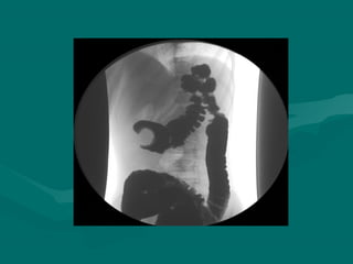 Intussusception Claw Sign