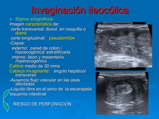 Invaginación intestinal | PPT