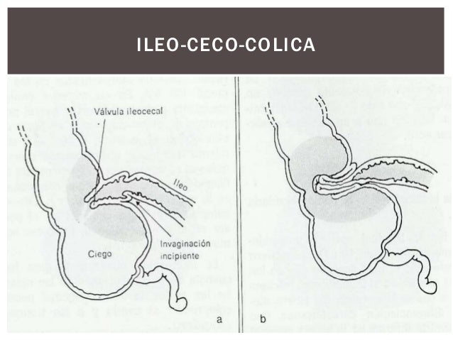 Invaginación intestinal