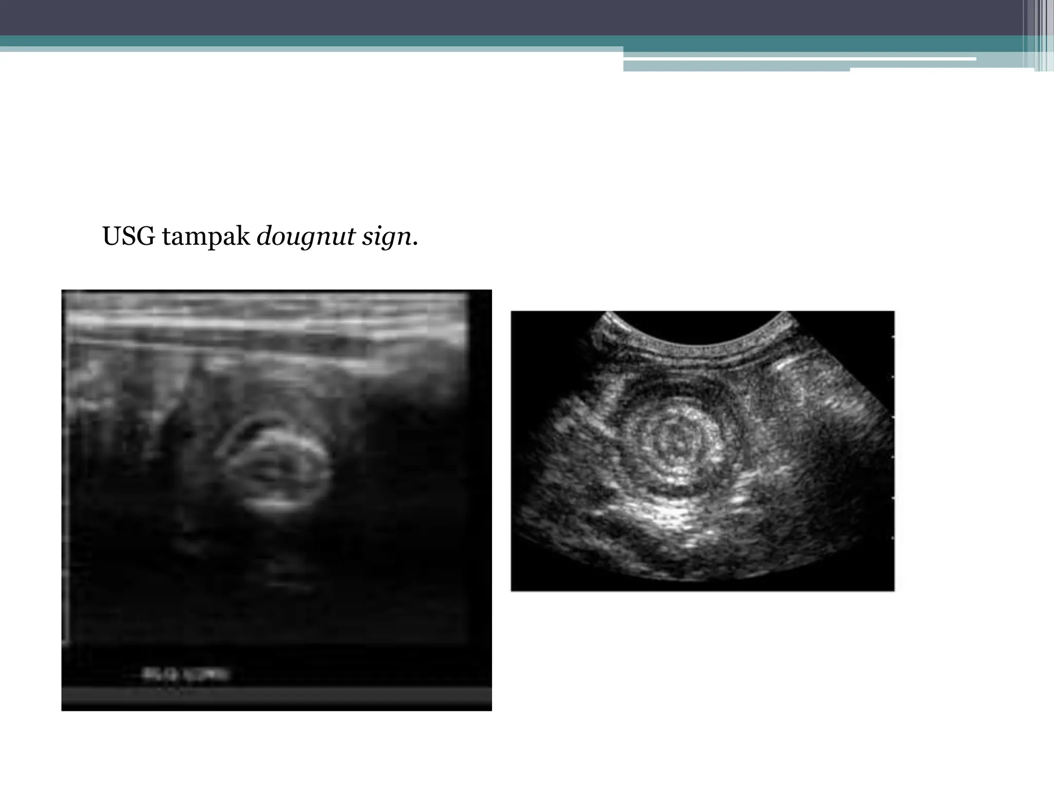 Invaginasi. sqs ppt | PPT