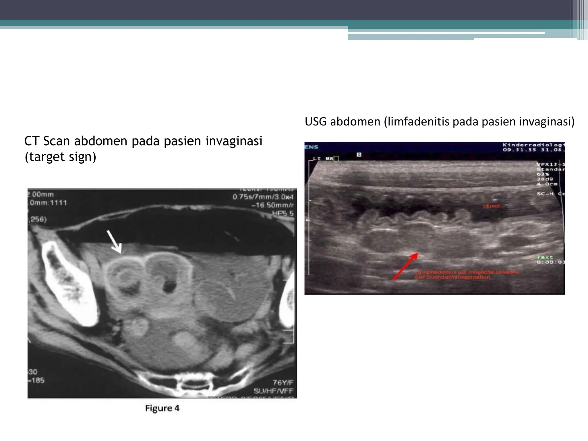 Invaginasi. sqs ppt | PPT