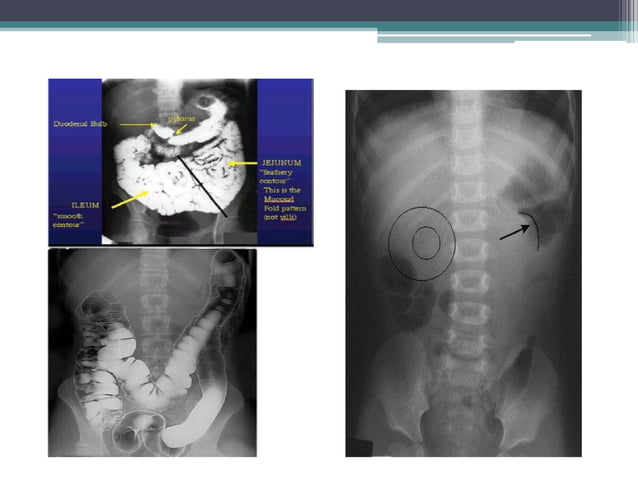 Invaginasi. sqs ppt | PPT