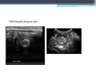 Invaginasi. sqs ppt | PPT