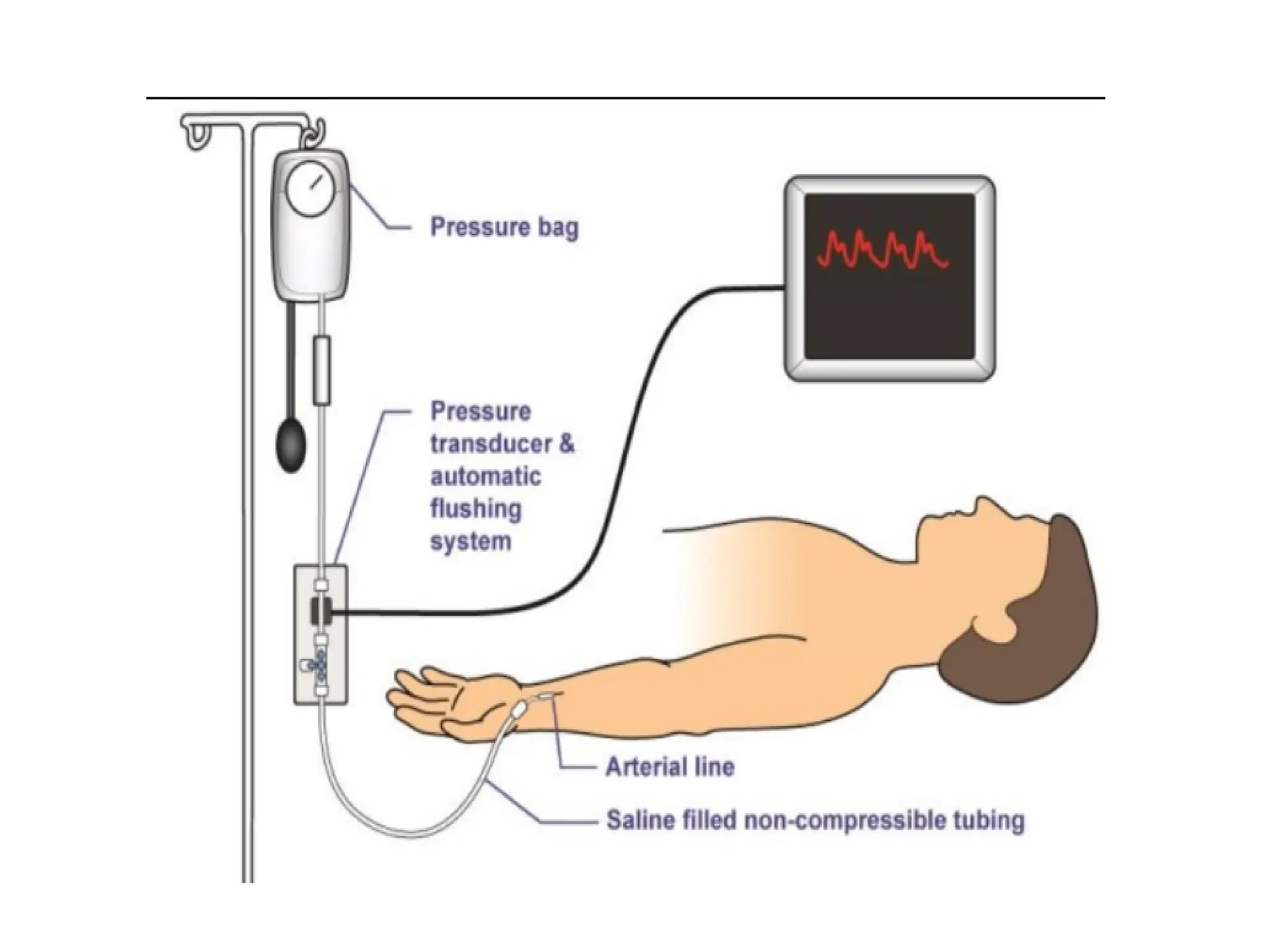 Invasive arterial BP monitoring by Weaam Abdalla | PPT
