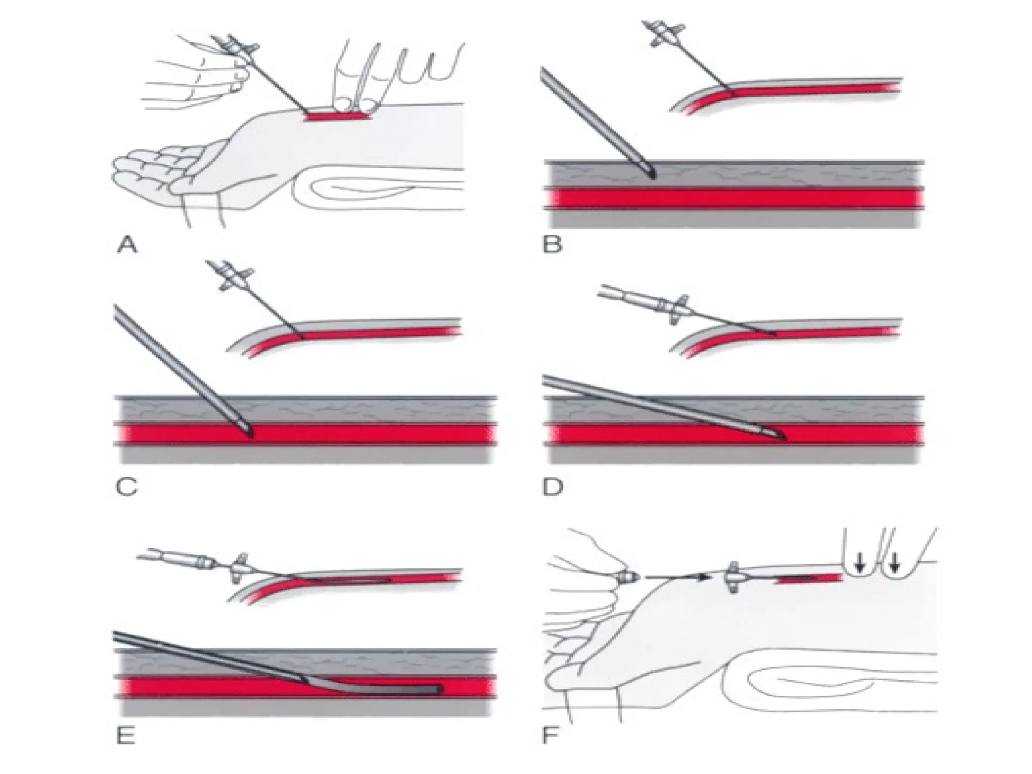 Invasive arterial BP monitoring by Weaam Abdalla | PPTX