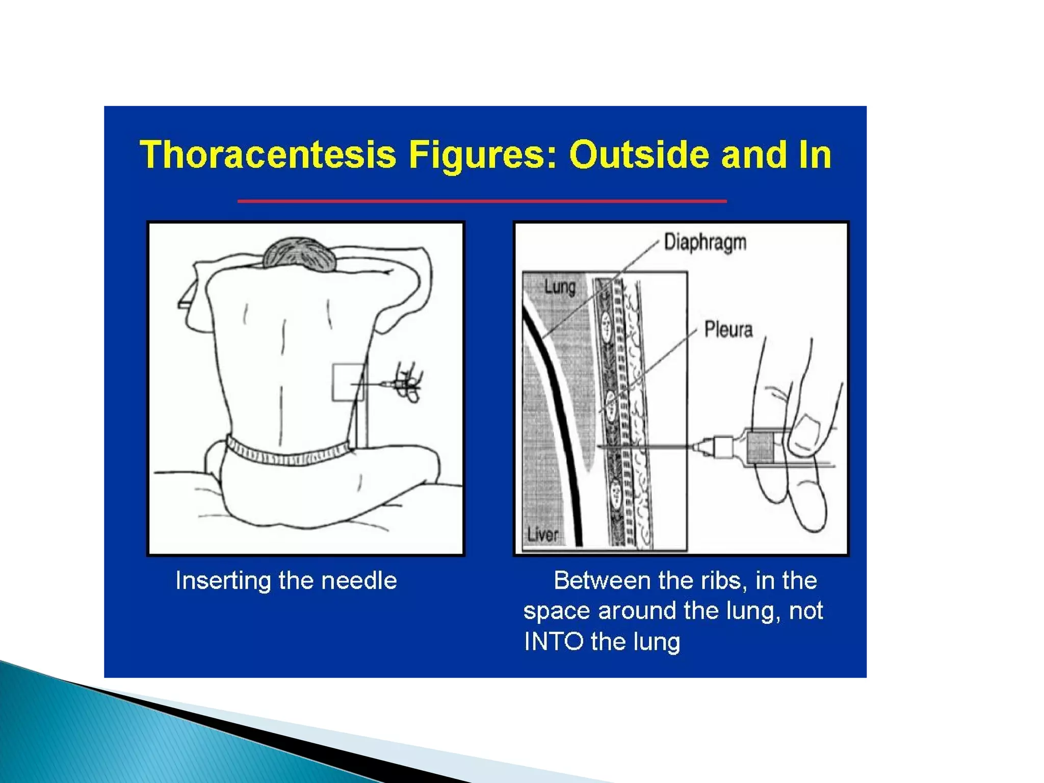 Invasive diagnostic methods of chest, the trachea | PPT