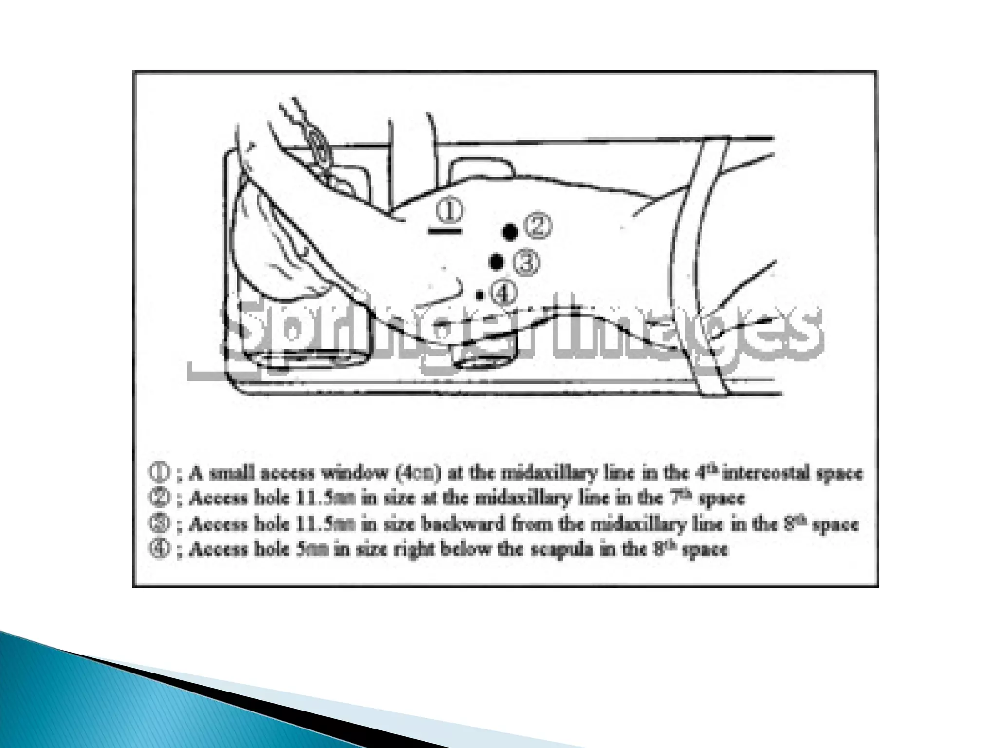 Invasive diagnostic methods of chest, the trachea | PPT