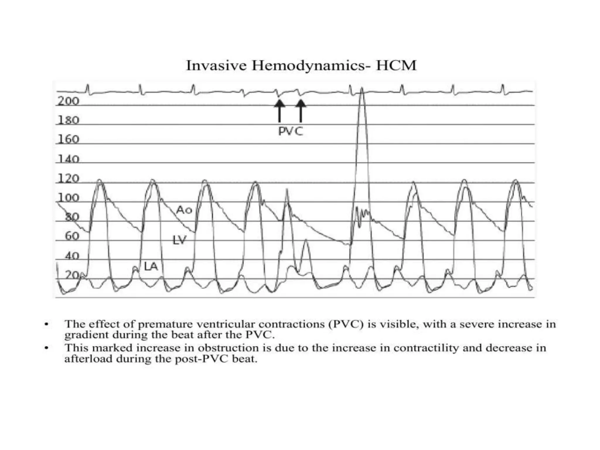 Invasive hemodynamics of constrictive pericarditis | PPTX