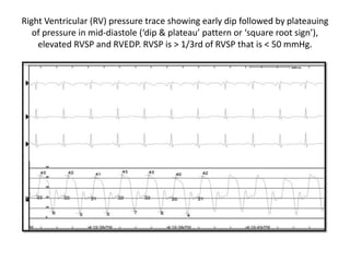 Invasive hemodynamics of constrictive pericarditis | PPTX