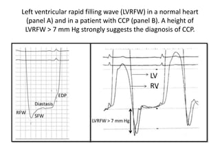 Invasive hemodynamics of constrictive pericarditis | PPTX